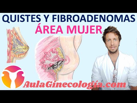 QUISTES Y FIBROADENOMAS de MAMA: Qué son y qué repercusiones tienen. - Ginecología y Obstetricia -