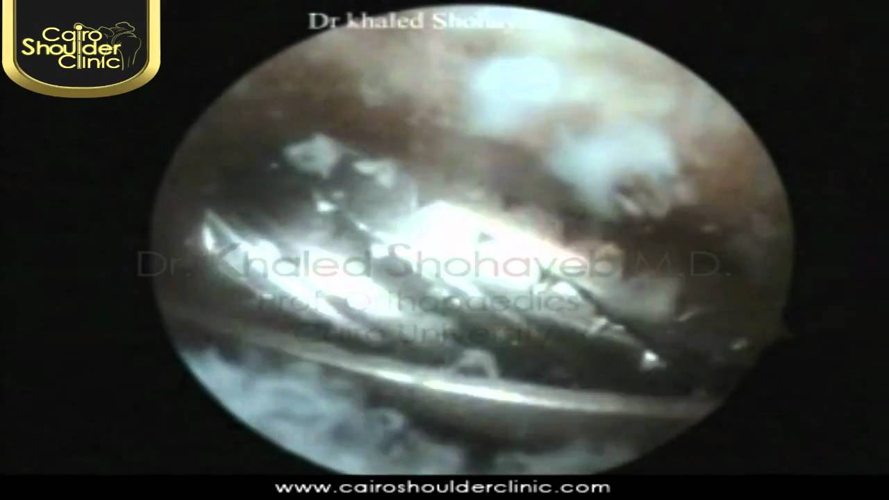 Acromioclavicular impinging spur removal - YouTube