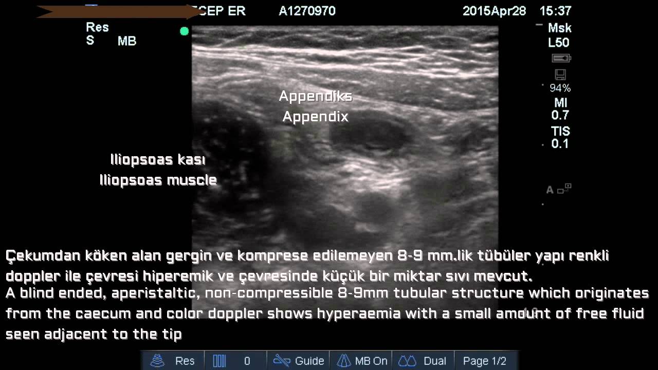 Ultrasound: Acute Appendicitis - YouTube