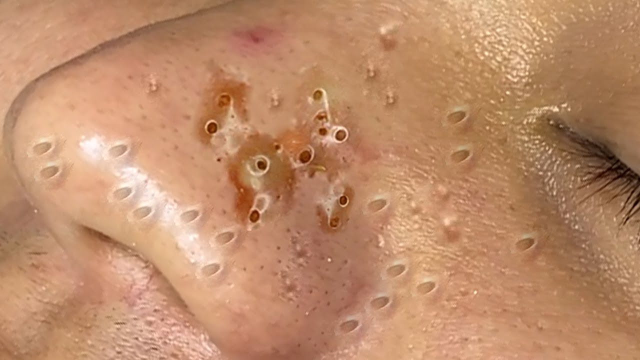 Best Satisfying Pimples Popping Cyst Removal Acne Blackheads #1224 ...