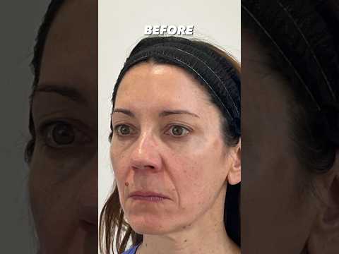 Sculptra Before and After | Lake Tahoe, CA | Sculptra Face Sacramento | Sculptra Near Me West Sac CA