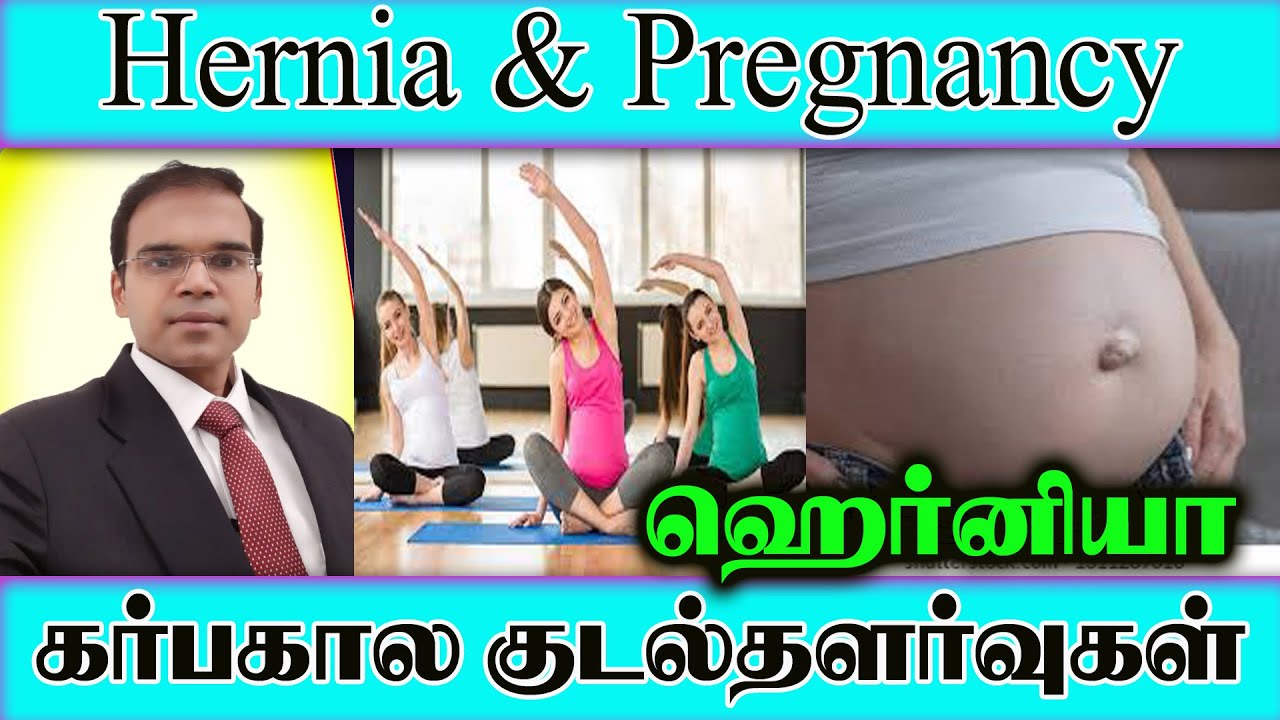 Pregnancy hernia Divarication of recti கர்ப்பகால ஹெர்னியா ,laparoscopic ...