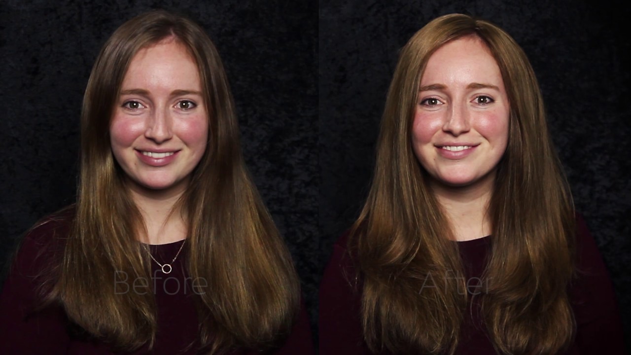 Putting on a Custom Designed Dermal Lens - YouTube