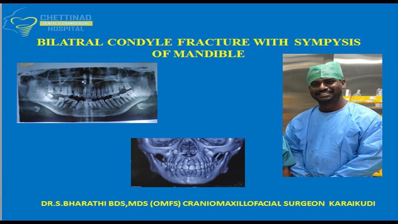 BILATERAL CONDYLE WITH SYMPHYSIS OF MANDIBLE FRACTURE - YouTube