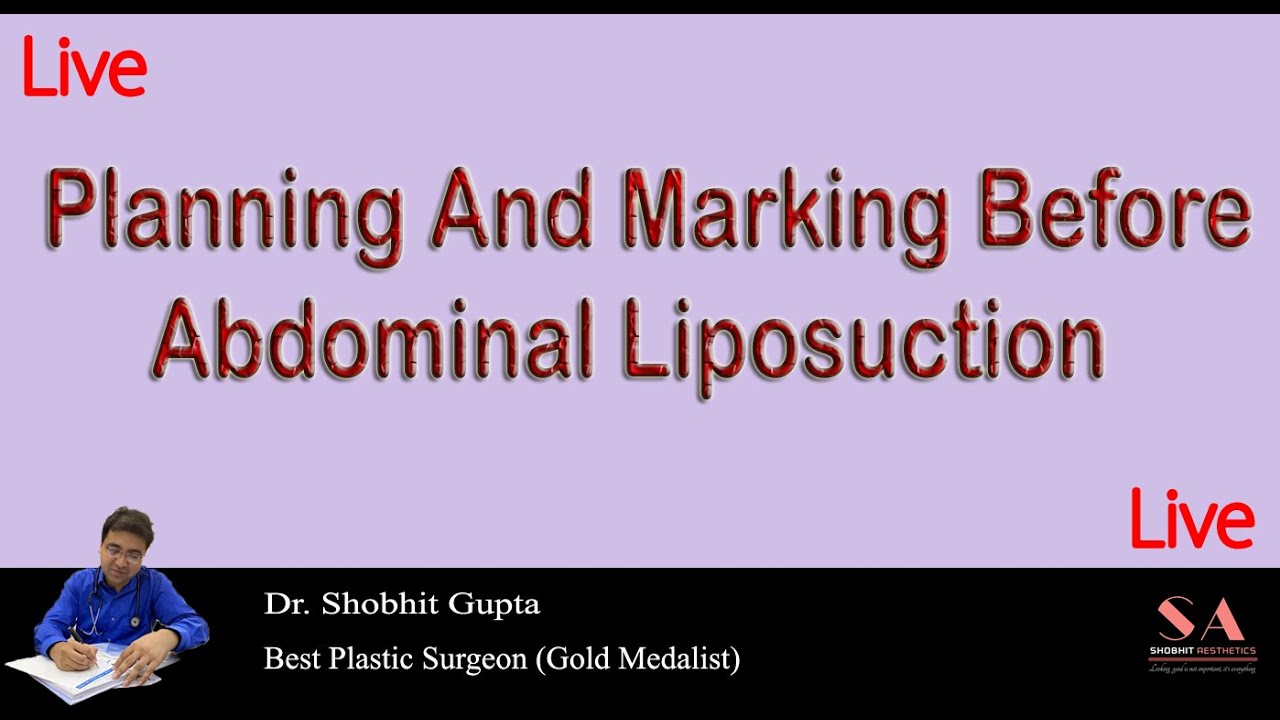 LIVE Liposuction Marking | Dr. Shobhit Gupta - YouTube
