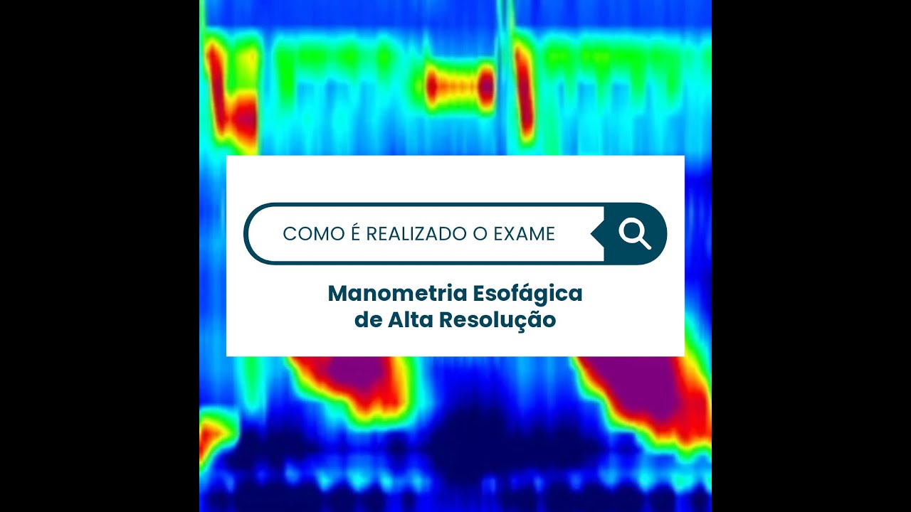Manometria Esofágica de Alta Resolução: Entenda como é feito! - YouTube