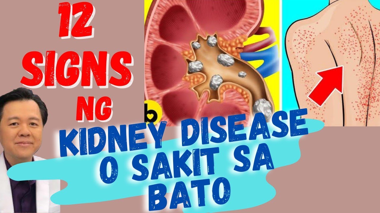 12 Senyales ng Kidney Disease o Sakit sa Bato - Payo ni Doc Willie Ong ...