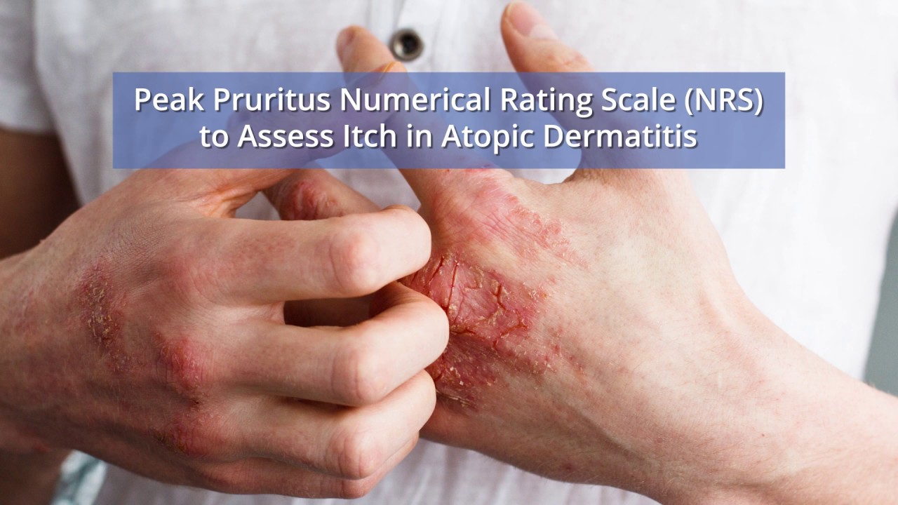 Validation of the Peak Pruritus Numerical Rating Scale, G. Yosipovitch ...