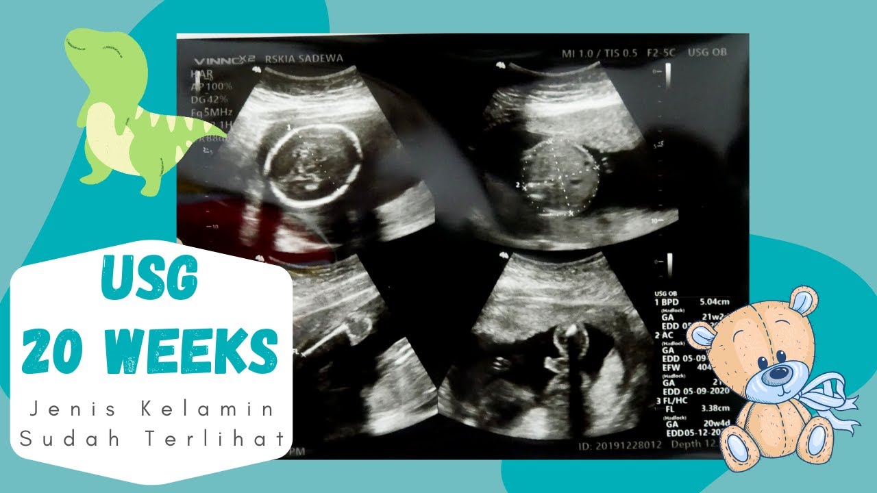 USG 20 WEEKS - Jenis Kelamin Sudah Terlihat - USG 5 bulan - USG 20 ...