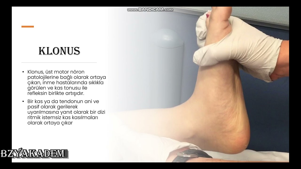 klonus, clonus - YouTube