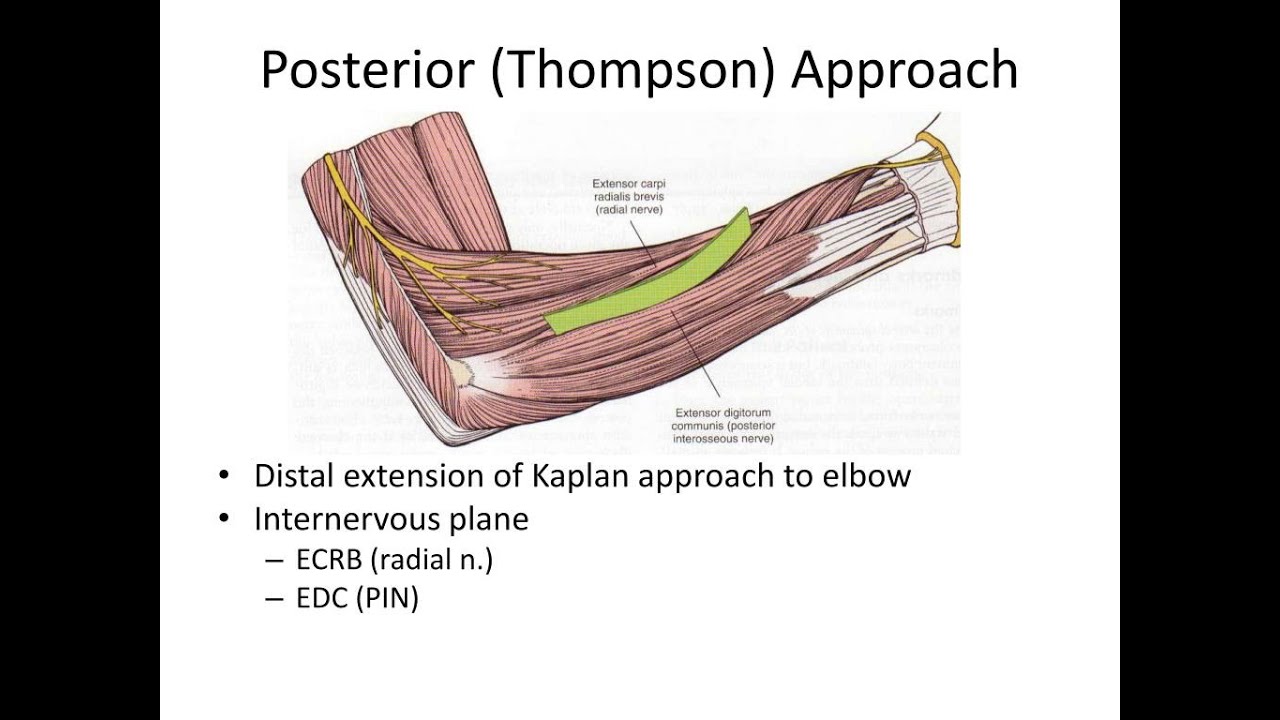 Dorsal Approach and Plating of a Proximal 1 3rd Radius Fracture ( Đường ...