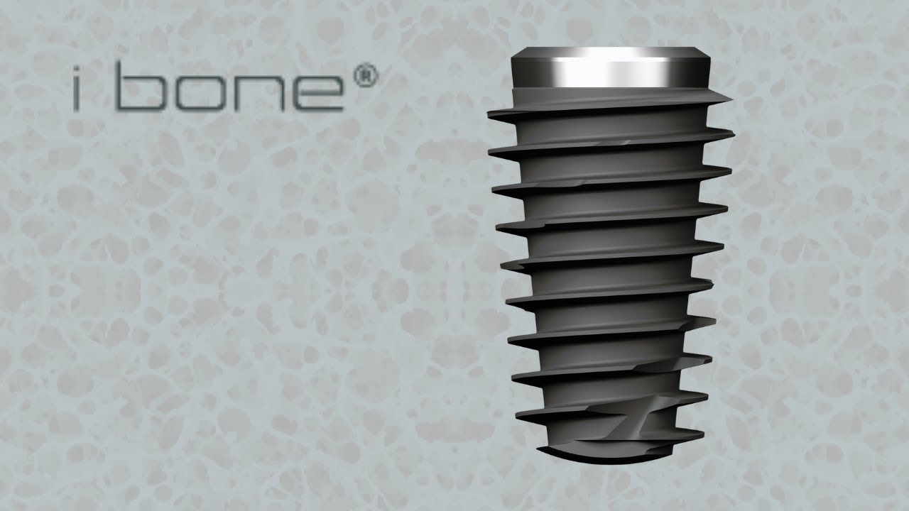 Implante iBone, conservación de lo esencial. - YouTube