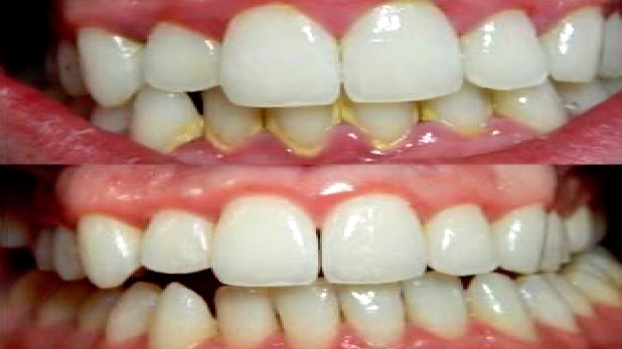 Scratch these two oils on your gums and teeth and you will not need to ...