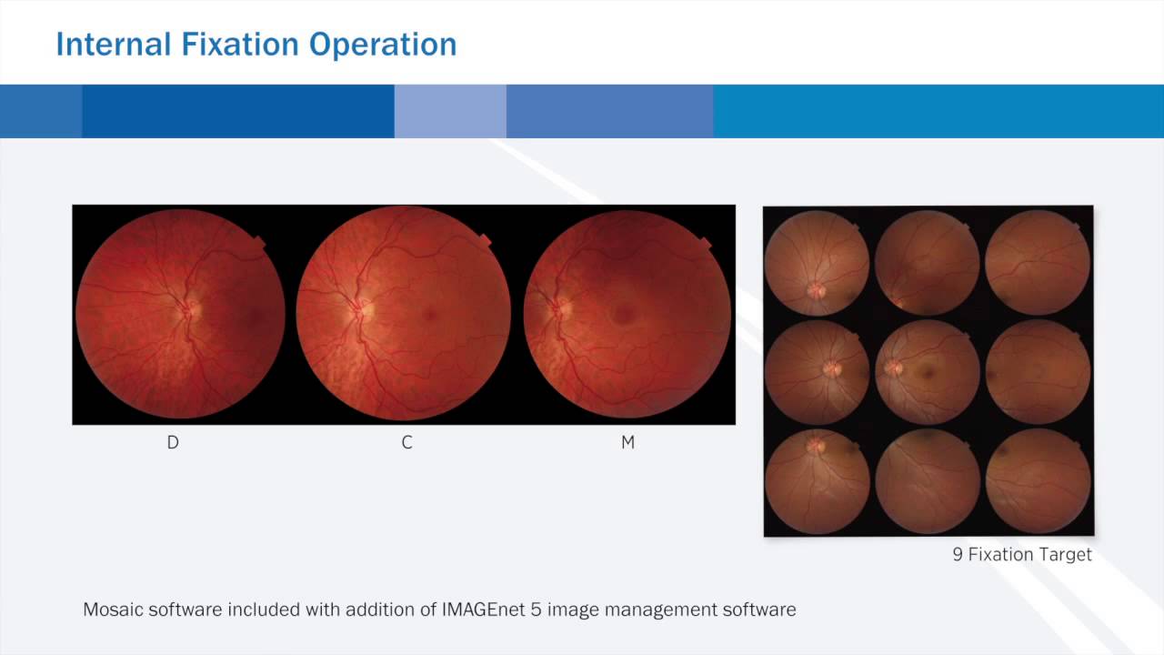 The Topcon TRC NW400 Retinal Camera - YouTube