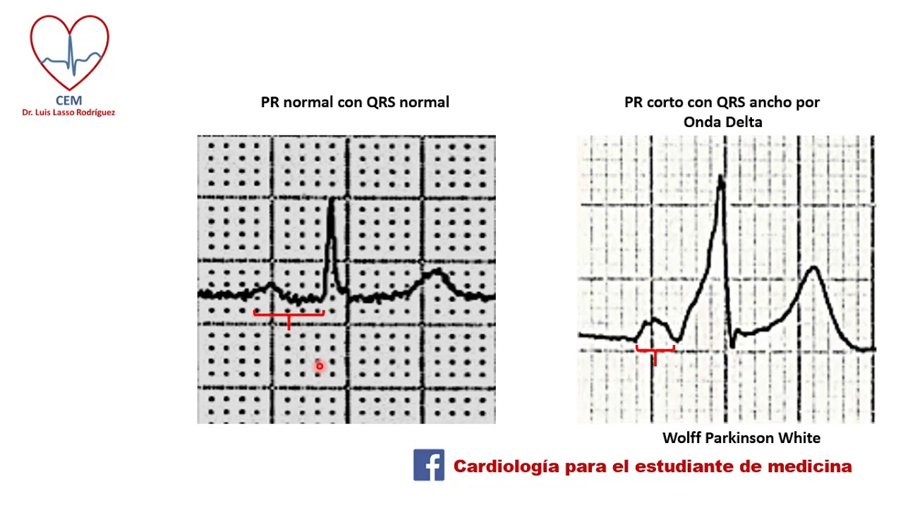 Onda Delta Da Sindrome Wpw Overview Of Wolff Parkinson White Syndrome