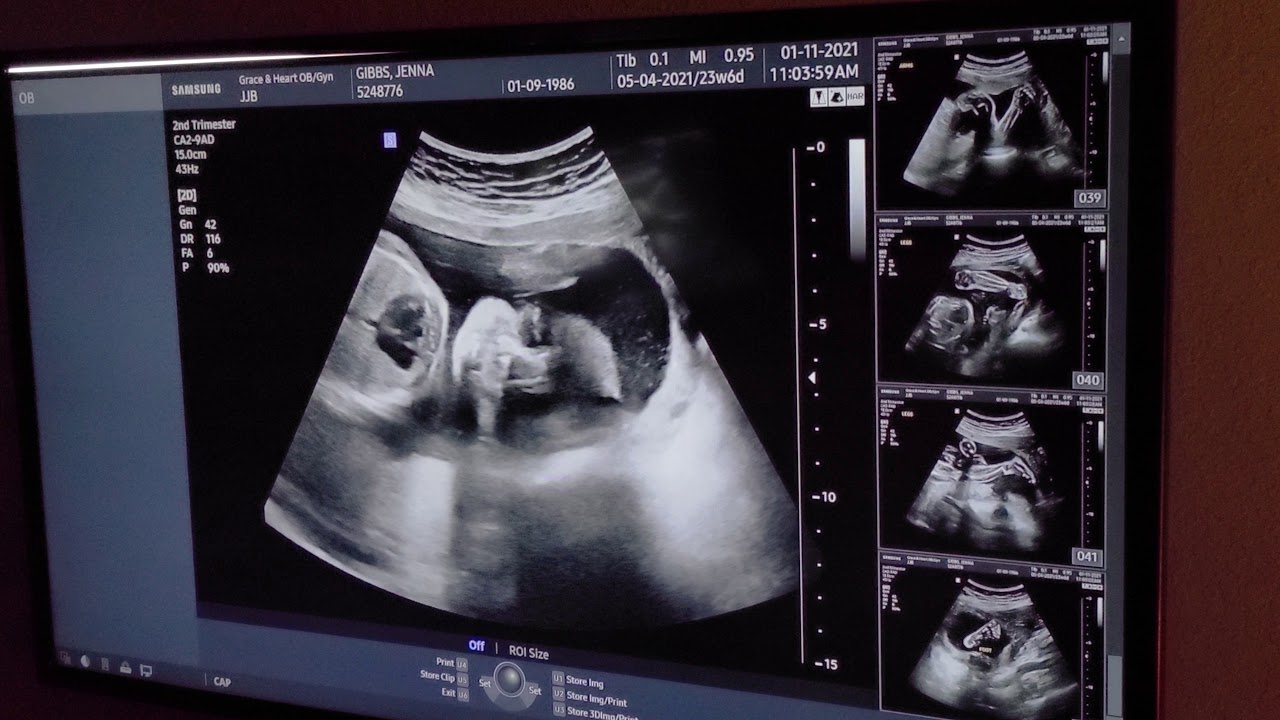 Gibbs Baby Boy 24 Week Ultrasound - YouTube
