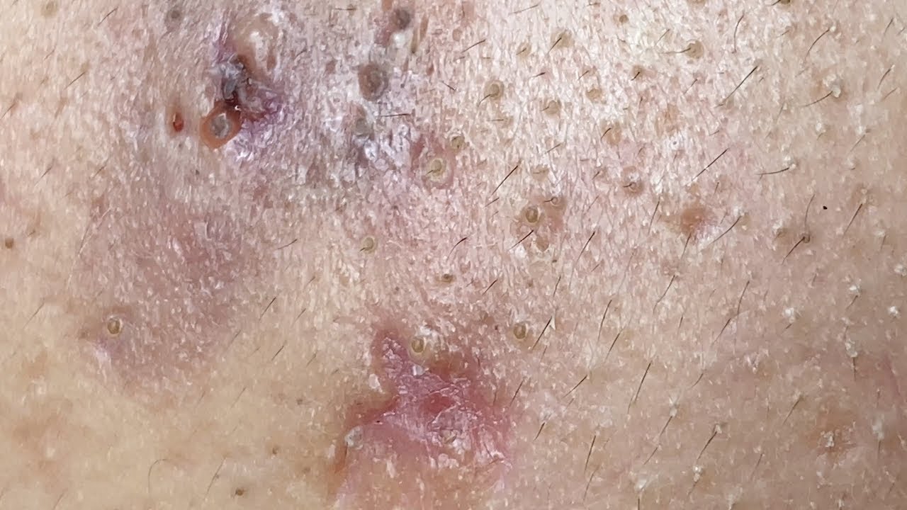 Make your Acne Treatment | Acne spa 1226 | Acne spa Treatment - YouTube