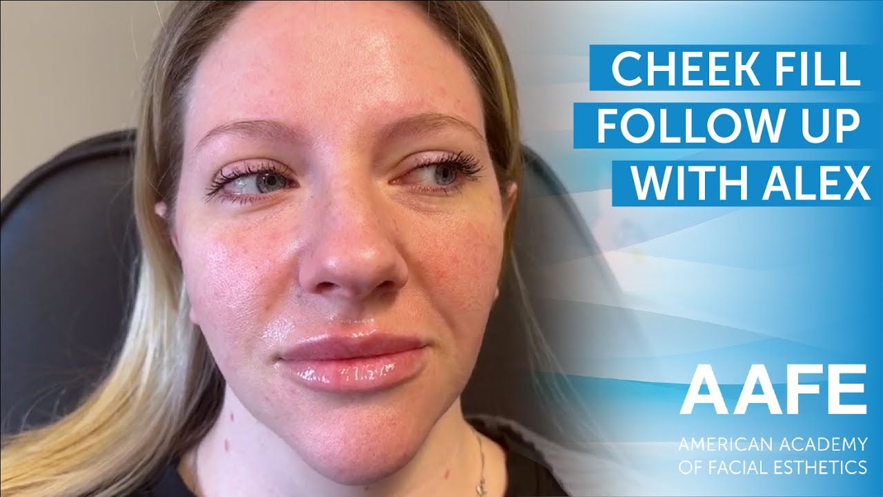Cheek Fill Follow Up with Alex - YouTube