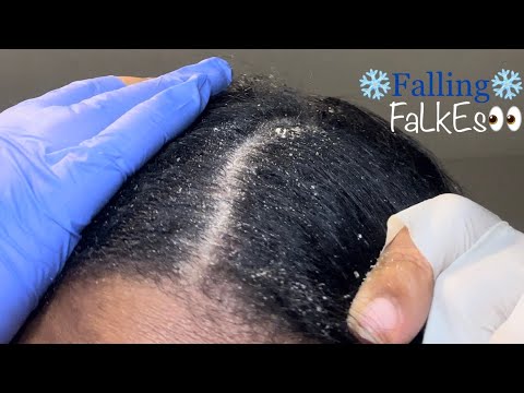 Dandruff Scratching Video “Lots of Falling Dandruff Flakes” - YouTube
