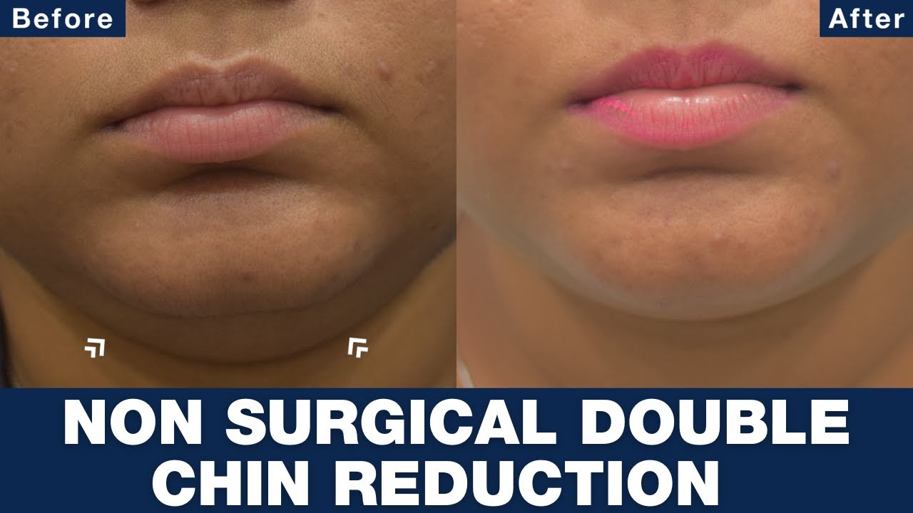 What is the most effective non-surgical method to eliminate a double ...