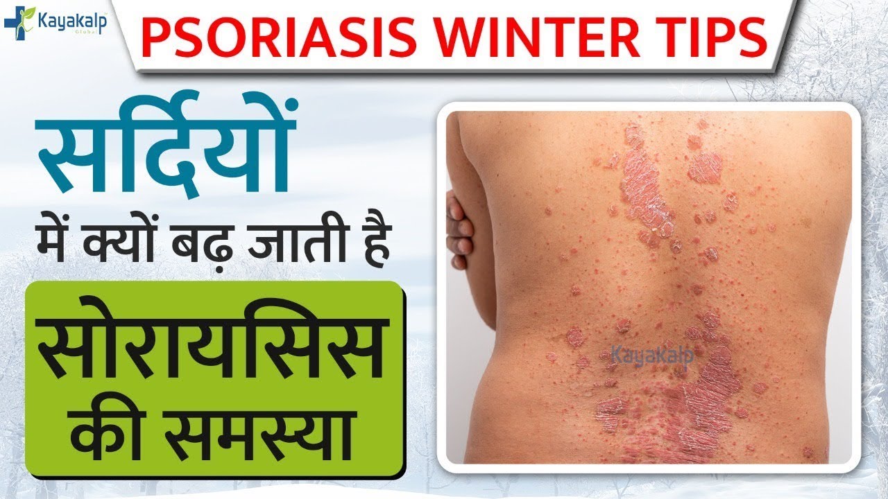 सर्दियों में #सोरायसिस की समस्या: Psoriasis Care in Winter | Best ...