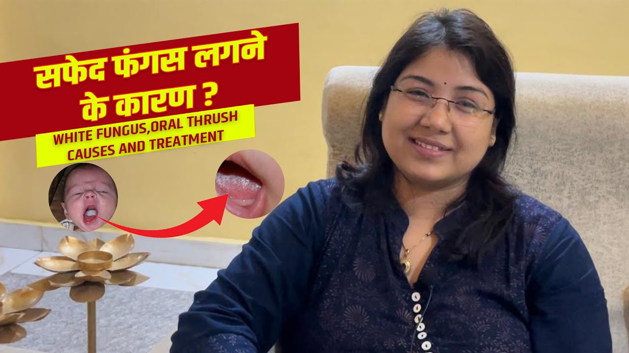 सफेद फंगस White Fungus, Oral thrush causes and treatment. - YouTube