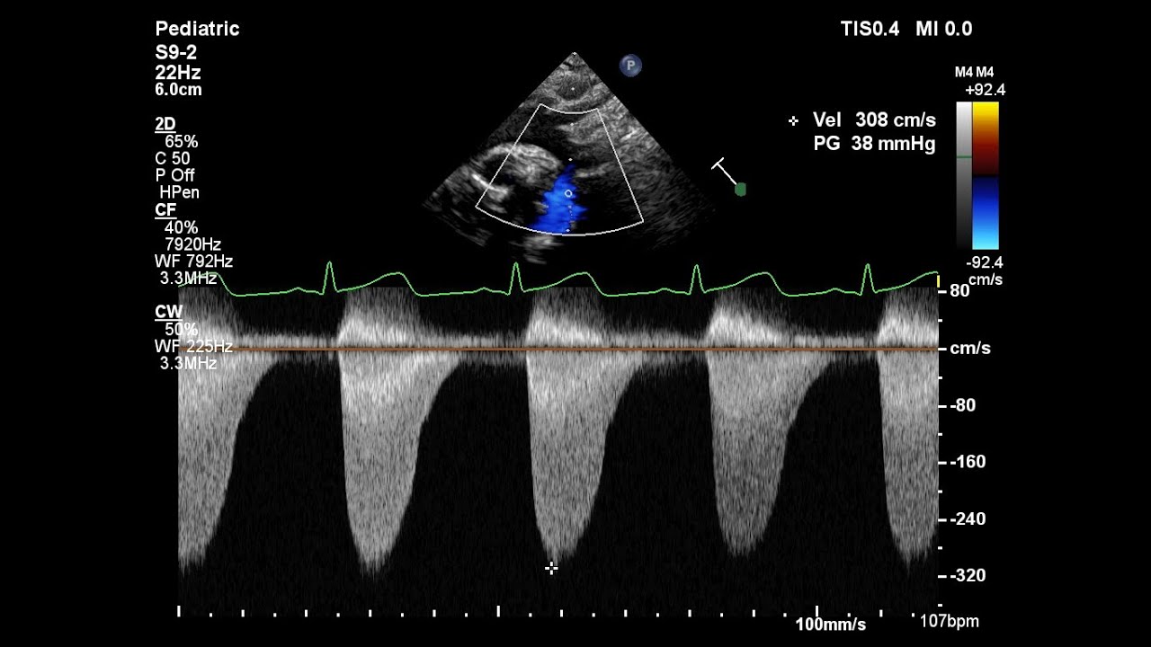 Basic echocardiography(심장 초음파 기본) - Coarctation of aorta(대동맥 축착) - YouTube