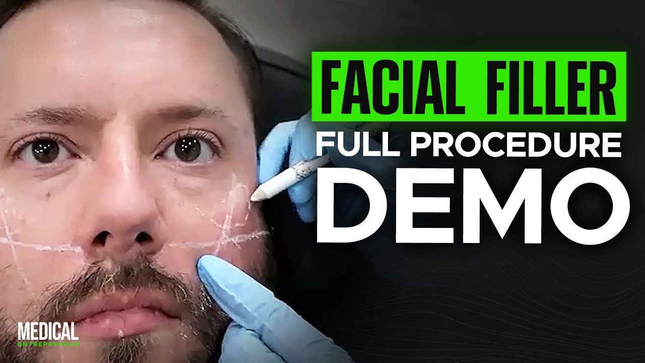 Performing a Dermal Filler Procedure on a Male Patient (Step-By-Step ...