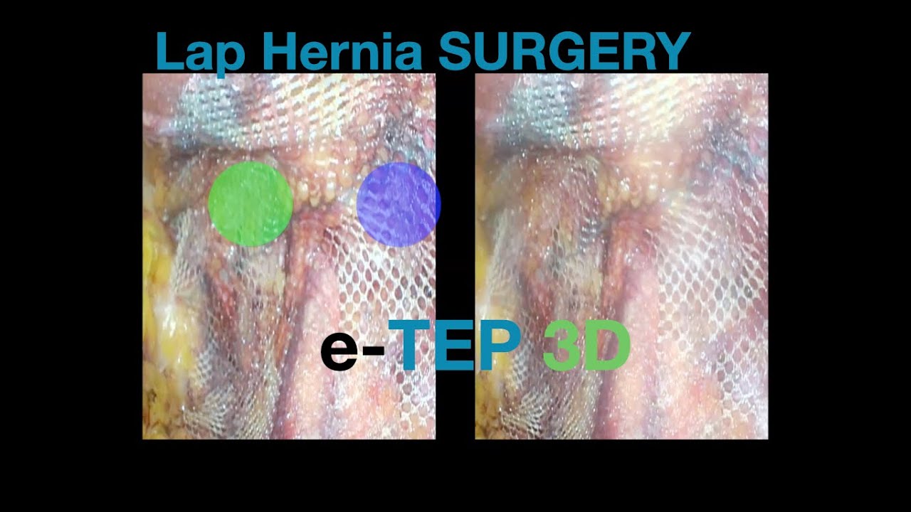 Hernia Inguinal - Laparoscopia e-TEP 3D - YouTube