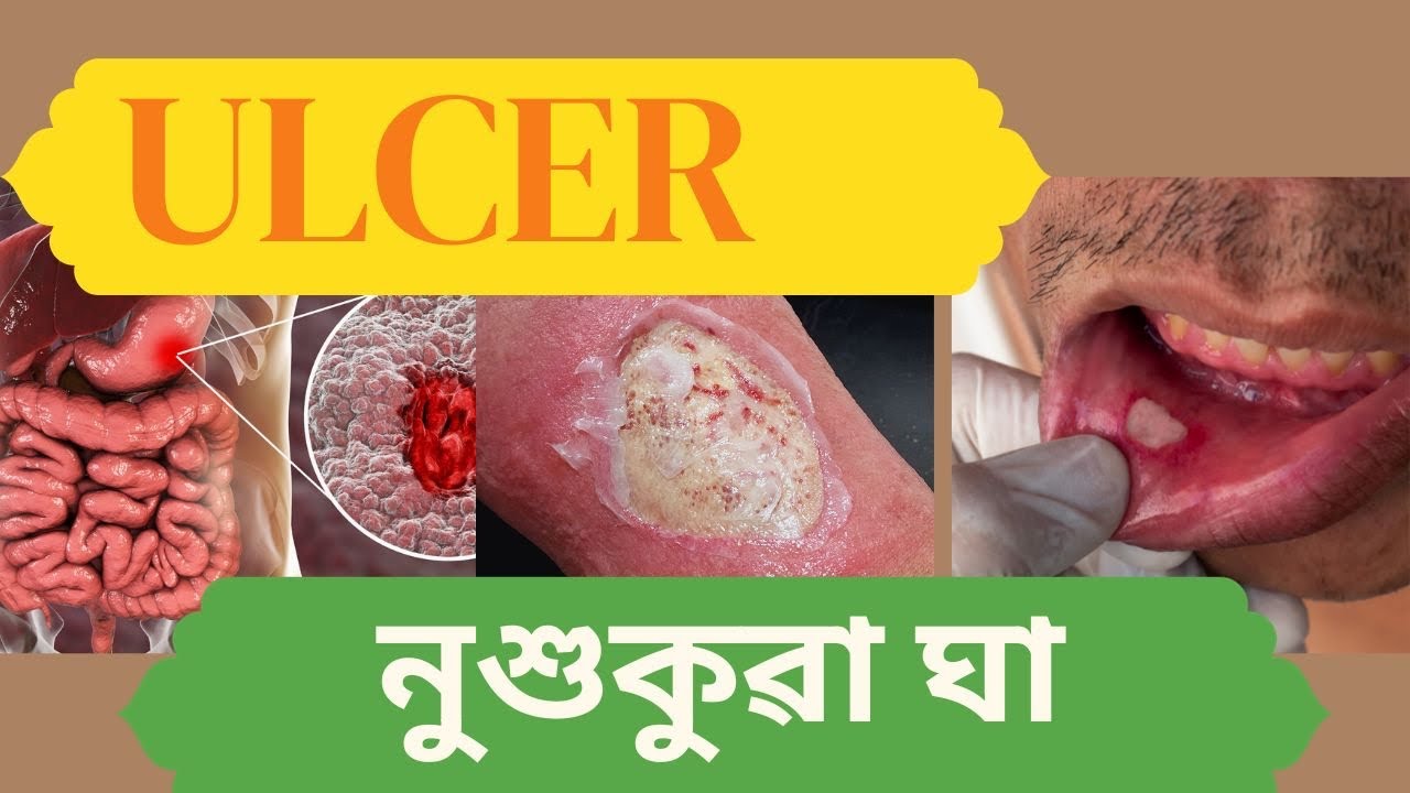 INTERNAL WOUND HEALING II ULCER , IBS, #acharya Pankaj Pathak - YouTube