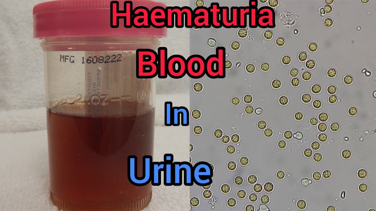 Hematuria Slide || Blood In Urine || - YouTube