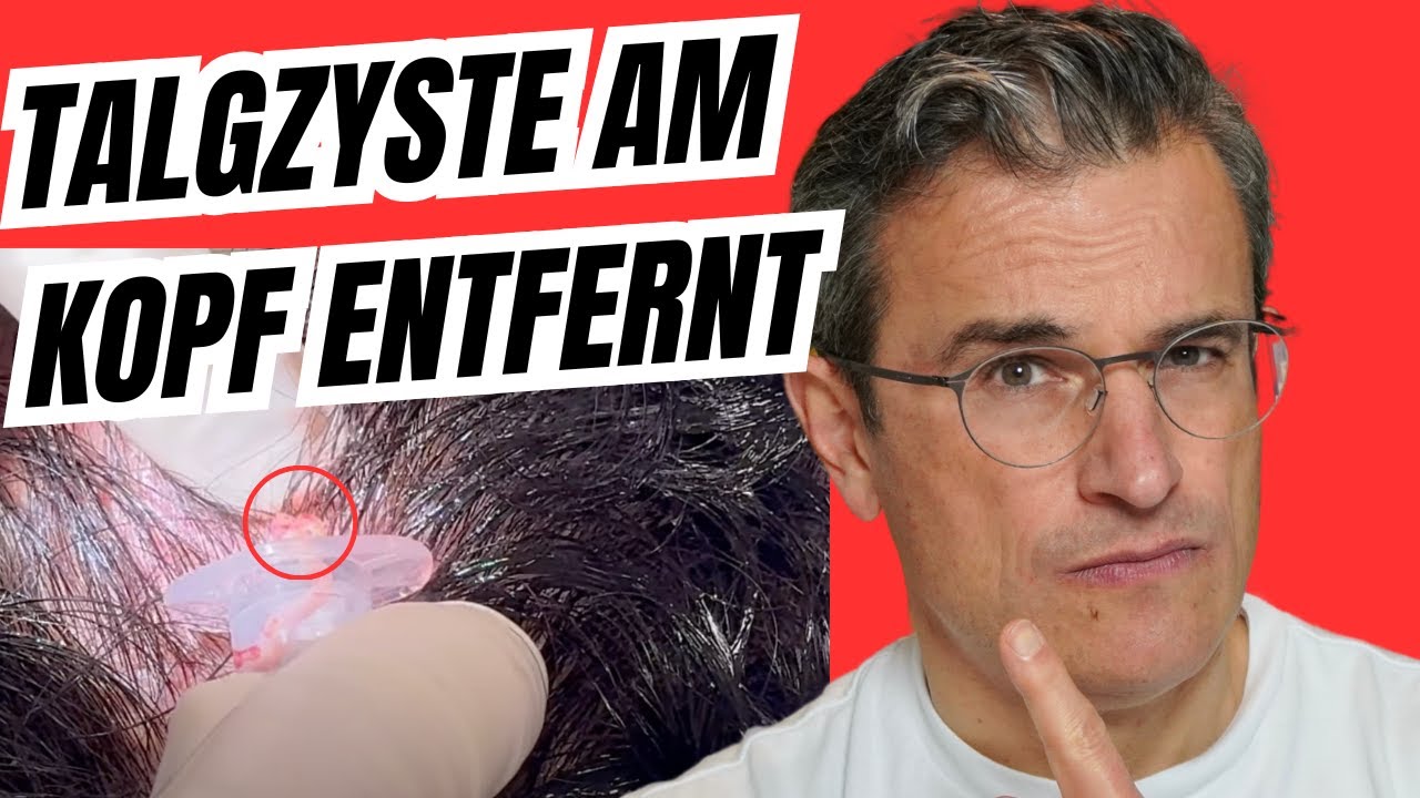 💥 Zyste am Kopf entfernen ohne Rasur: DANA-Verfahren erklärt | Dr. med ...