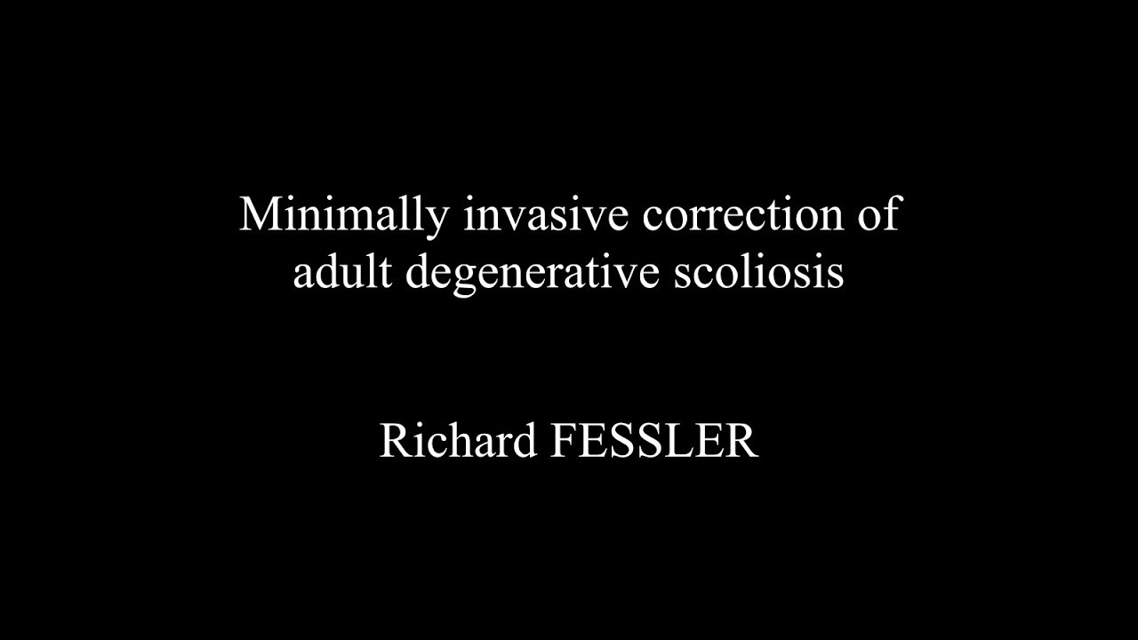 Minimally invasive correction of adult degenerative scoliosis. Richard ...