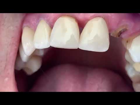 1 of 5 Preparation And Insertion Of High Tech 2 Unit Cantilever Bridge ...