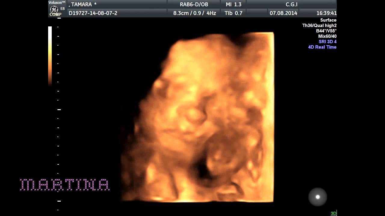 Ecografia 3D/4D 24 semanas Martina/ Ultrasonography 4D 24 weeks Martina ...