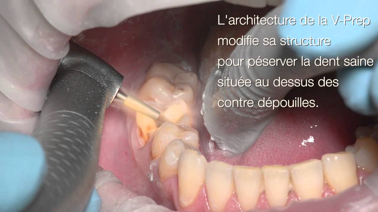 Crown Vprep overlay #12 Couronne esthétique en V-Prep complexe - YouTube
