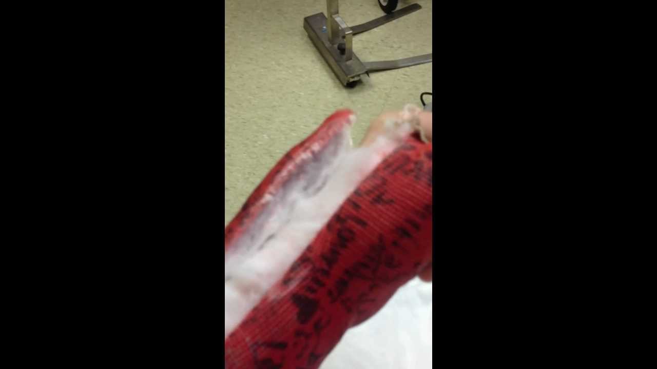 taking off a cast - YouTube