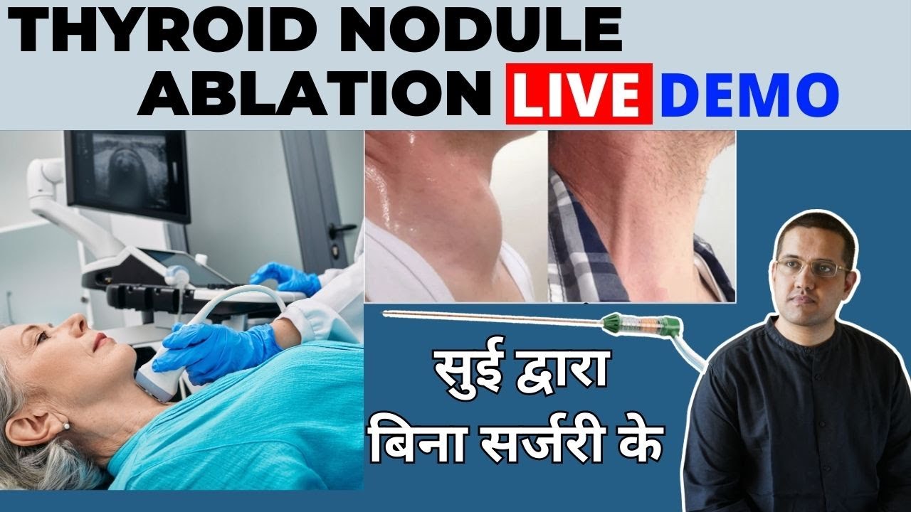 LIVE THYROID NODULE ABLATION | Non-surgical treatment of Thyroid Nodule | Dr. Gaurav Gangwani ...