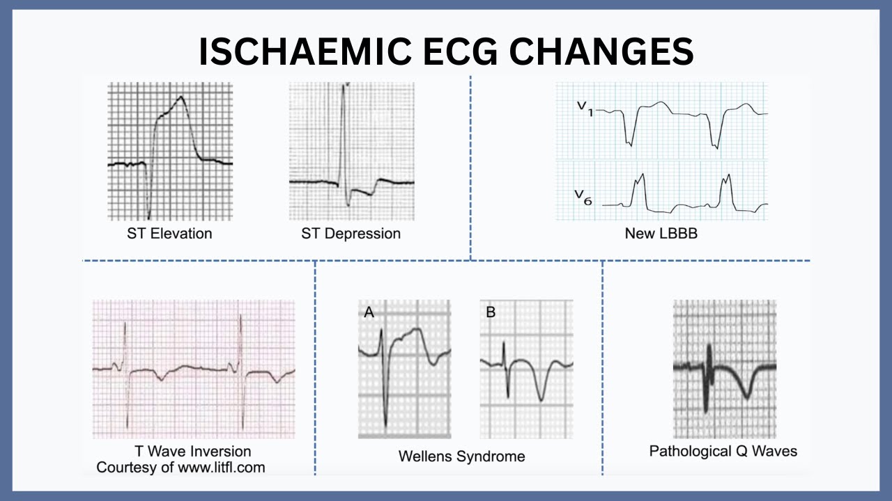 Ischaemic ECG Changes Explained - YouTube