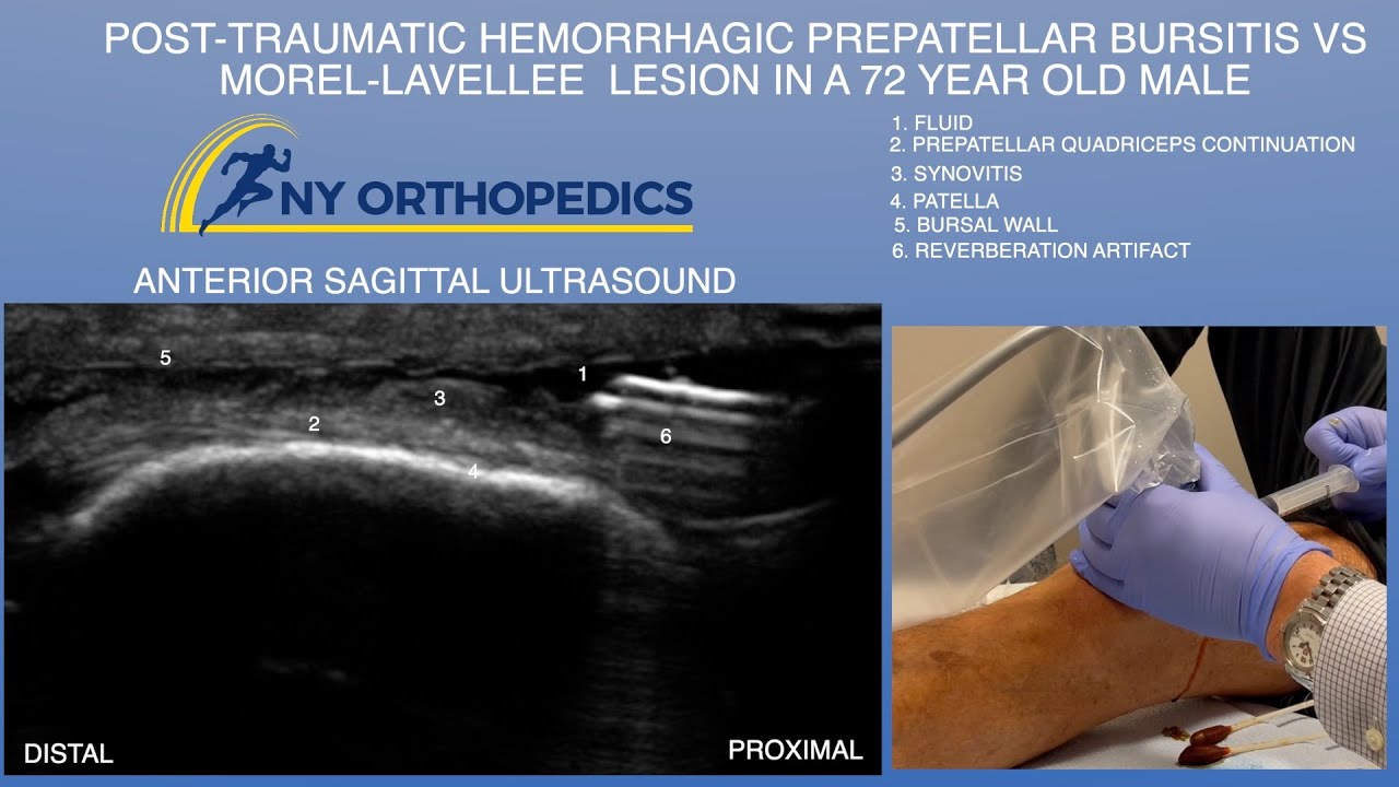 Ultrasound of a Post Traumatic Hemorrhagic Prepatellar Bursitis vs ...