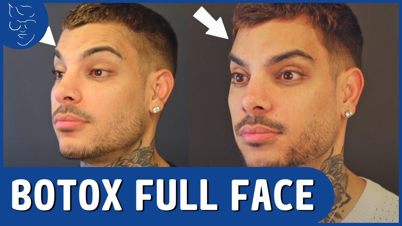 Un TRATTAMENTO per le Rughe - Risultati PAZZESCHI su Fredis Terrer 👀 ...