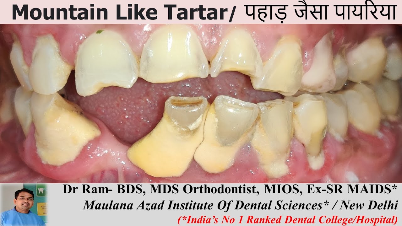 Mountain like Tartar Removal from Teeth 😱 😵‍💫I पहाड़ के जैसे पायरिया का ...
