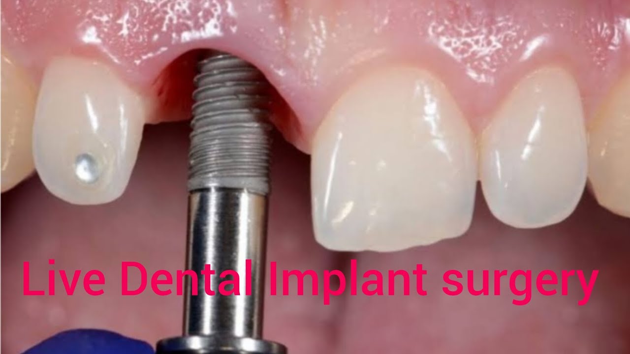 Live Dental Implant surgery (Upper maxillary canine Implant placement)🦷 ...
