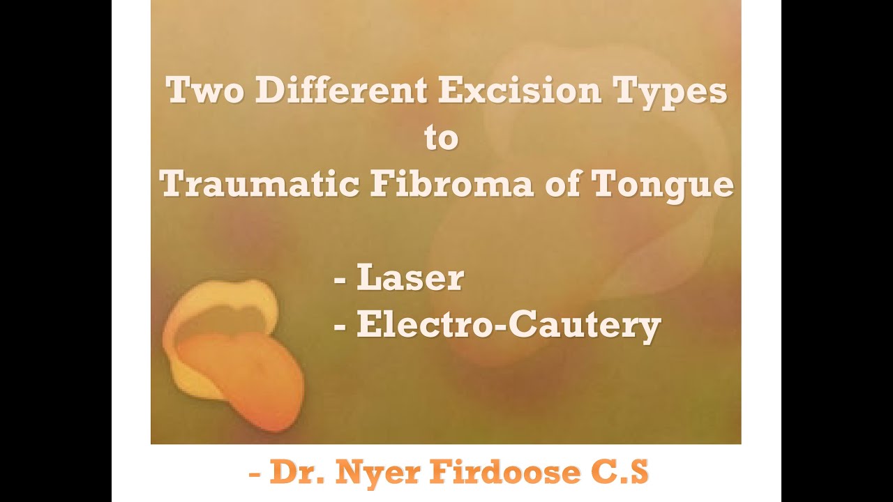 Two Different Excision Types to Traumatic Fibroma of Tongue - Dr Nyer ...