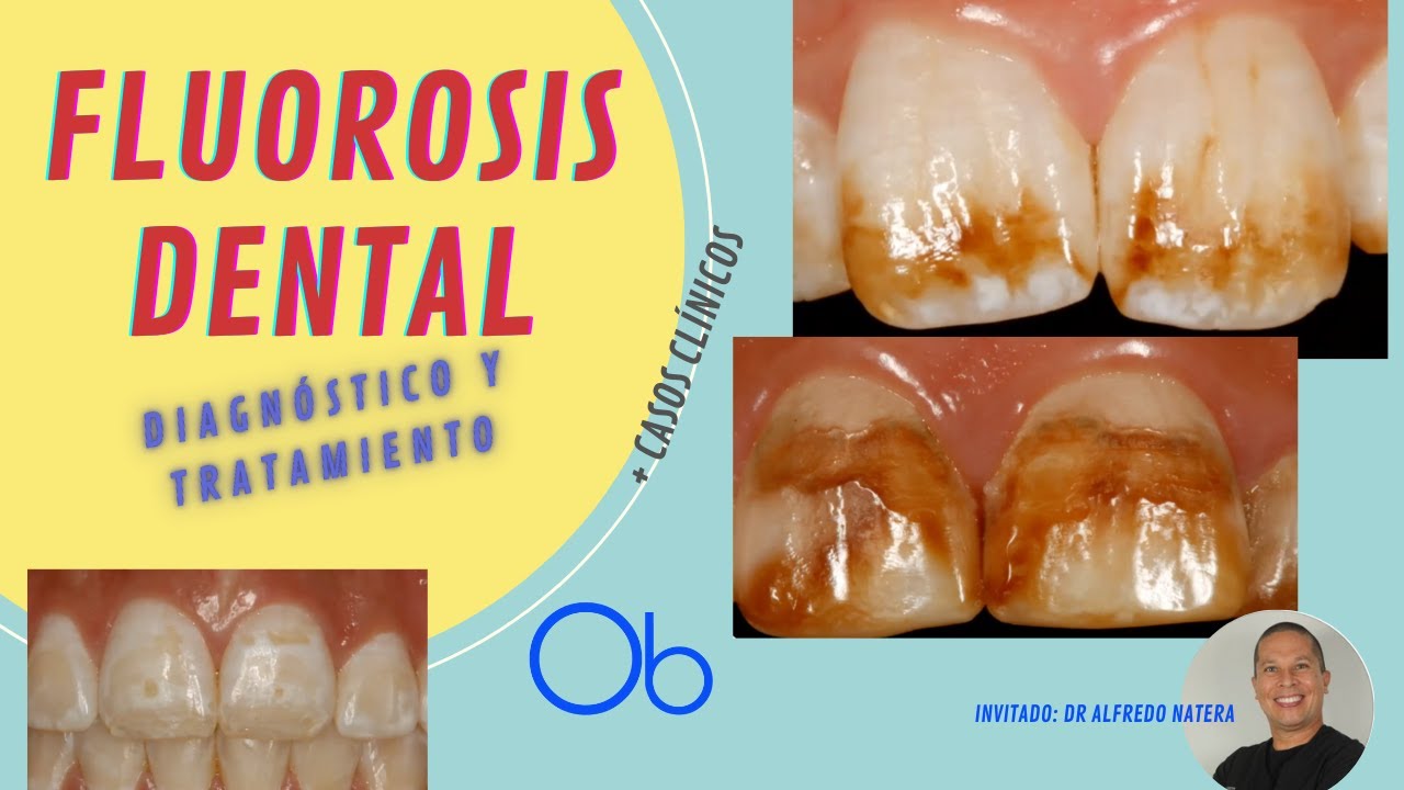 FLUOROSIS DENTAL: Diagnóstico y Tratamiento - YouTube