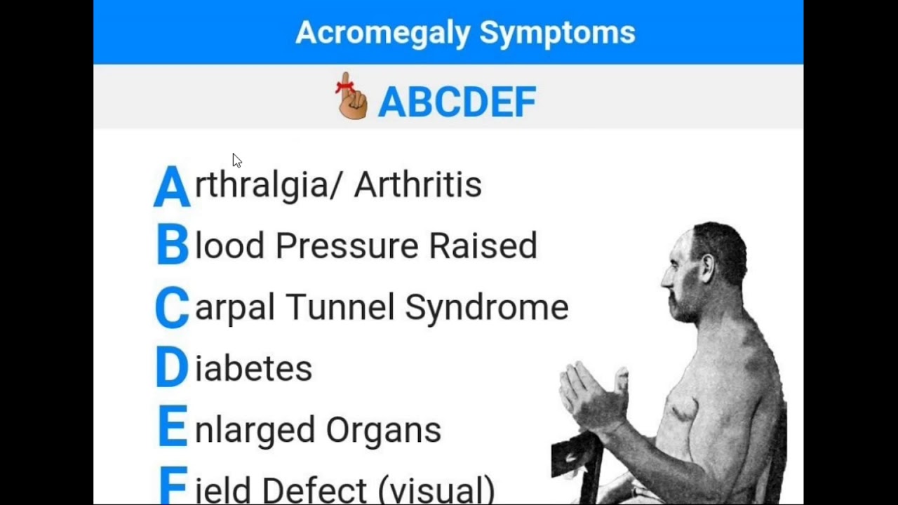 Acromegaly Symptoms Neumonic Picture , Easy To Remember - YouTube