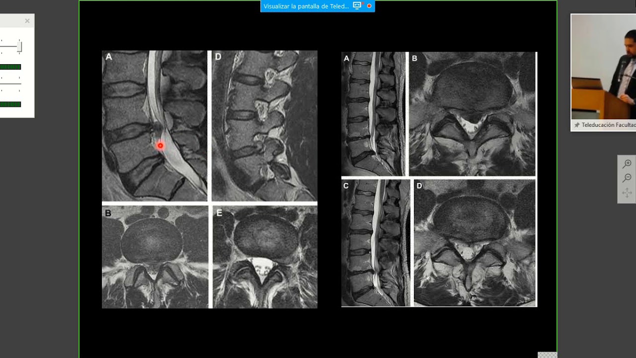 11 Enfoque paciente con dolor lumbar - YouTube