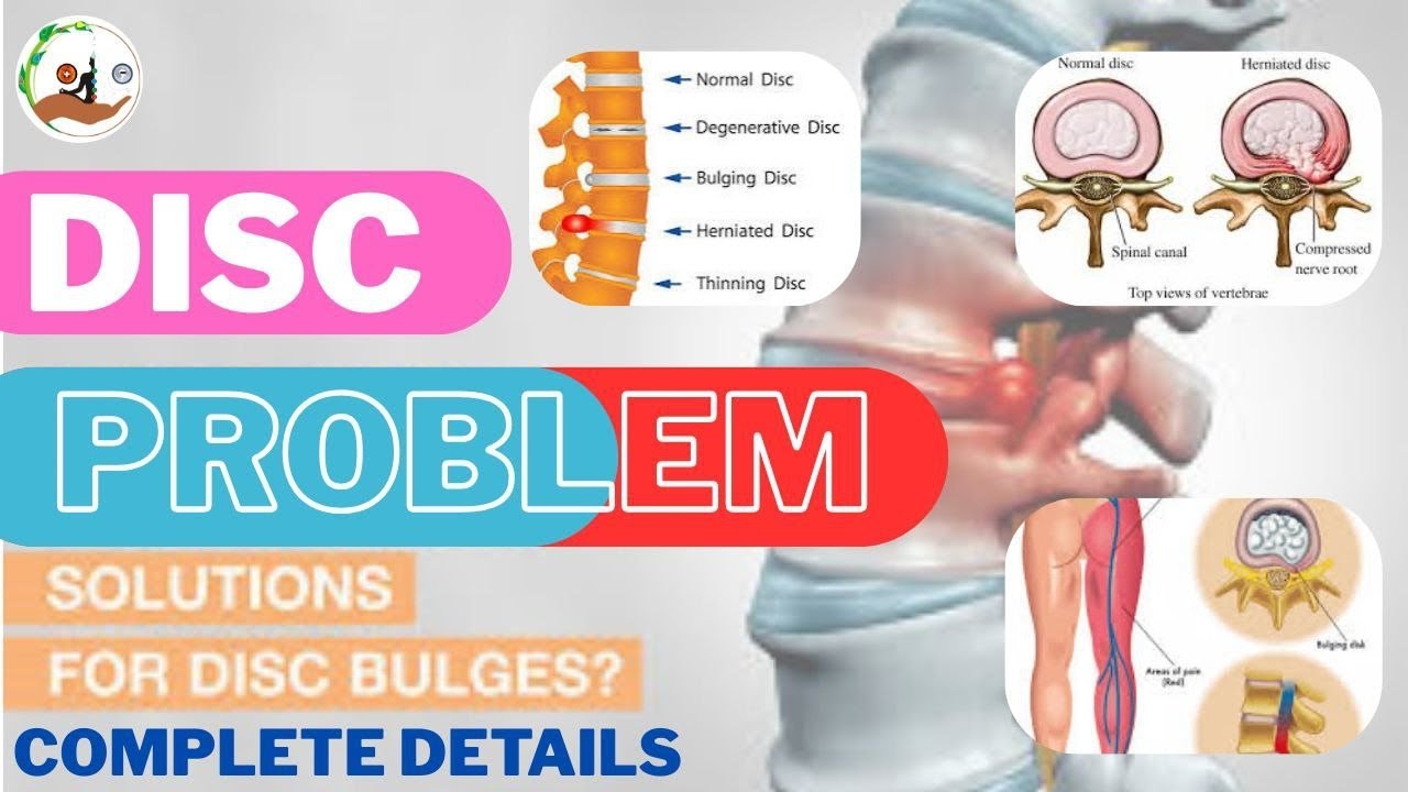 “Slip Disc, Herniated Disc, Bulge, Stenosis all Details About Disc ...