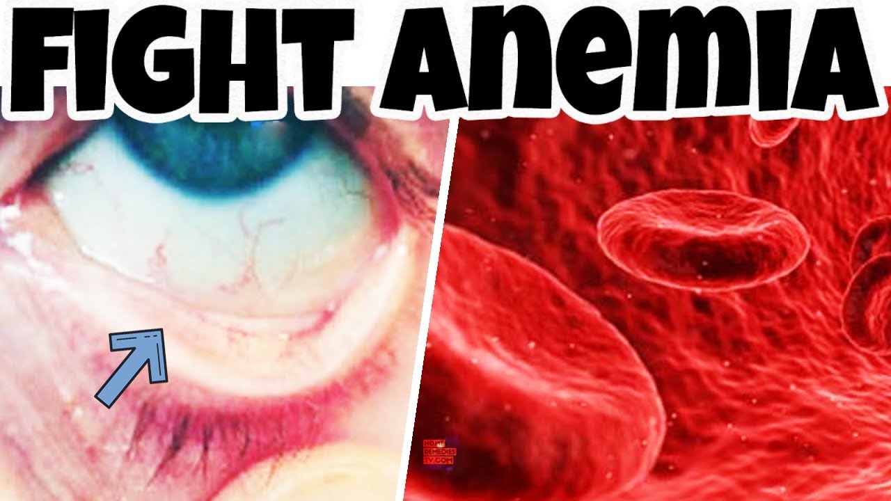 Top 4 Foods to Fight Anemia | Best Iron Rich Foods - YouTube