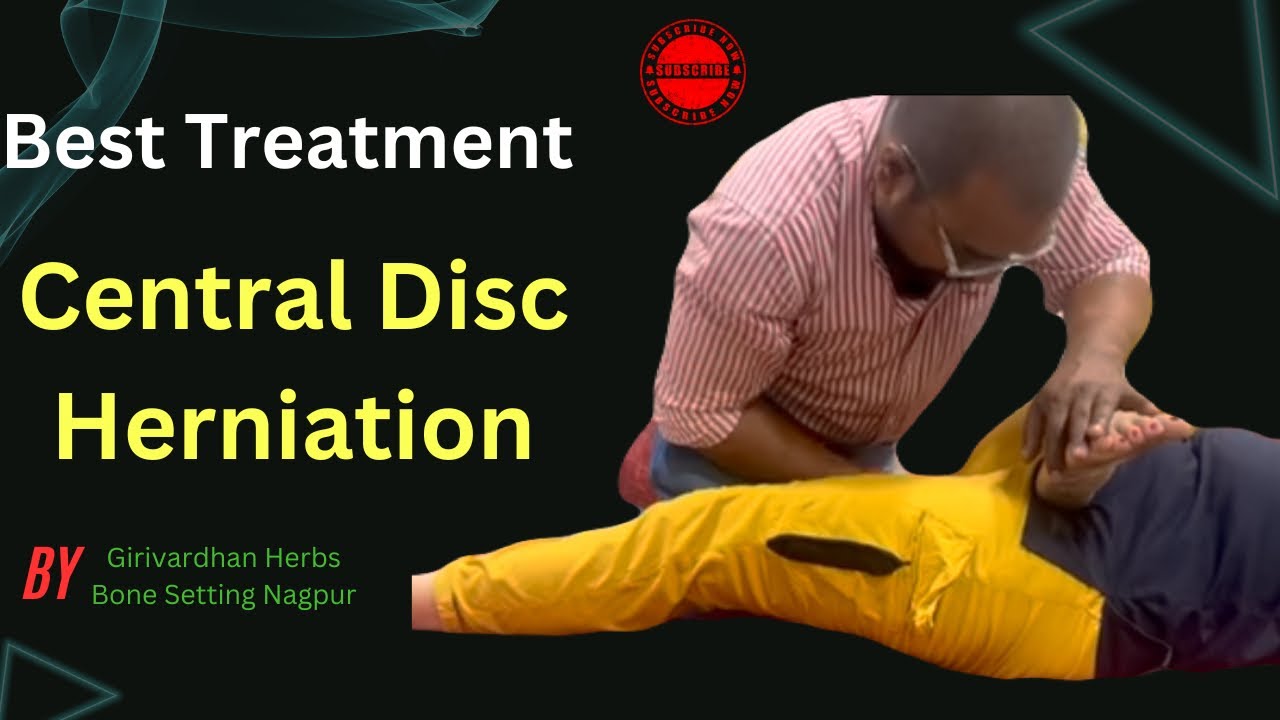 A Central Disc Herniation Is A Rare Condition | Disc Herniation ...